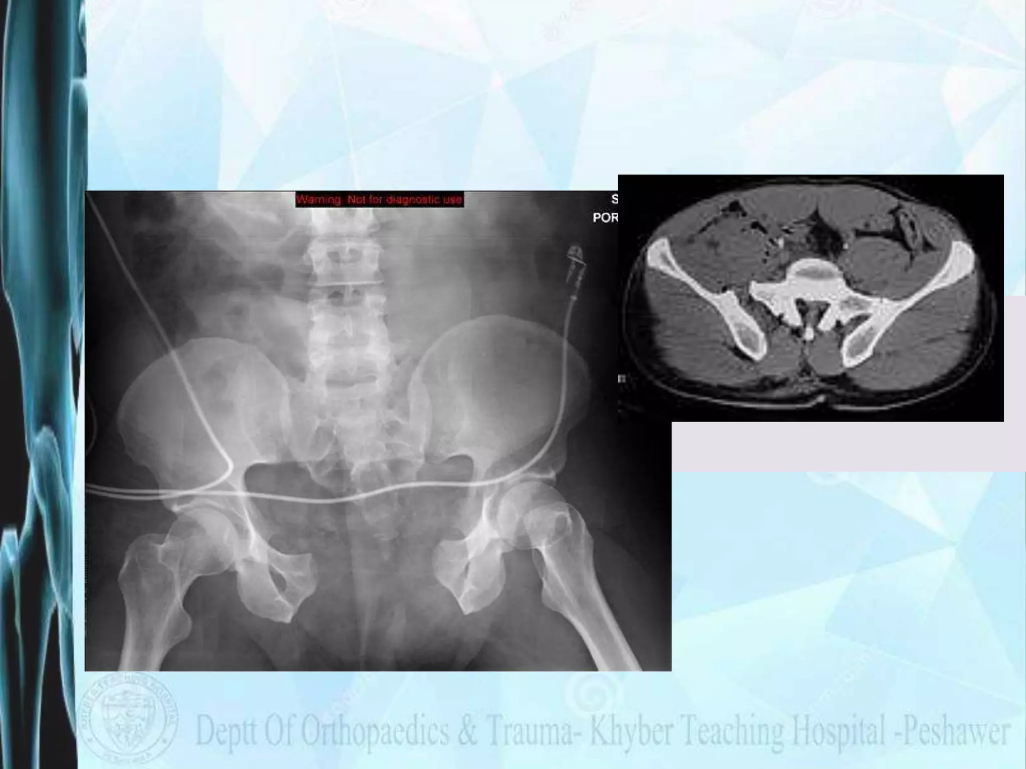 Pelvic fracture classification | PPTX