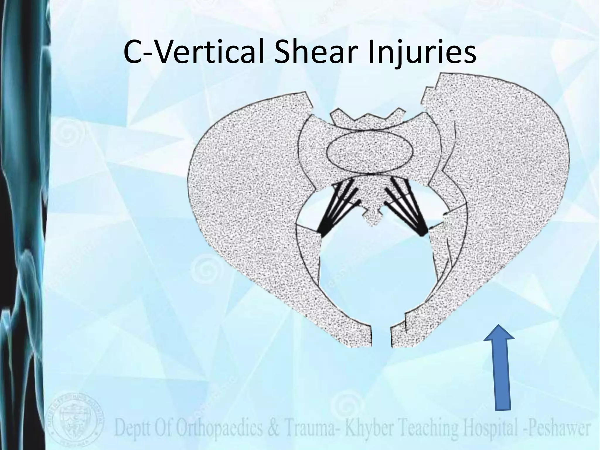 Pelvic fracture classification | PPTX