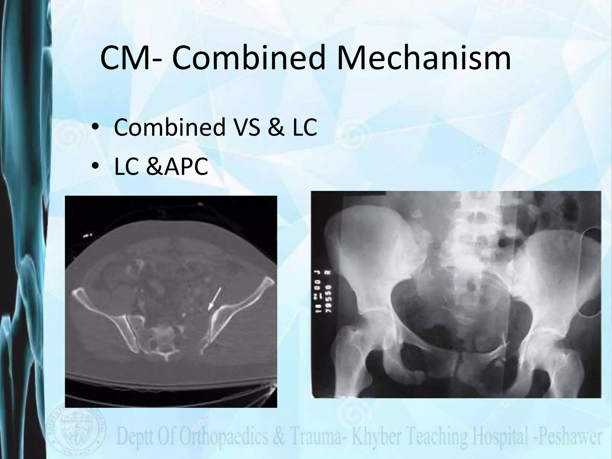 Pelvic fracture classification | PPT
