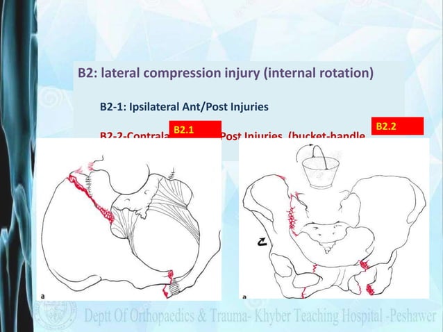 Pelvic fracture classification | PPTX