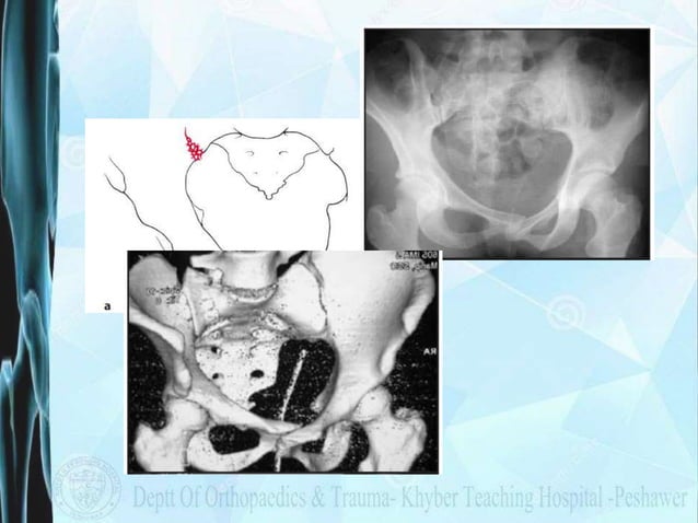 Pelvic fracture classification | PPTX