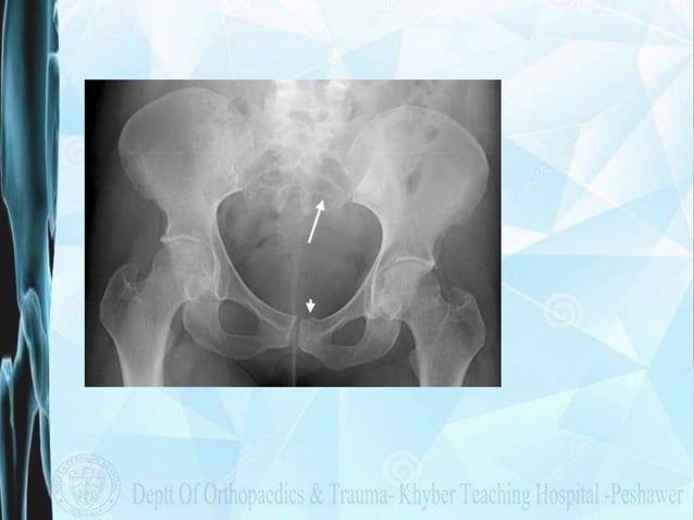 Pelvic fracture classification | PPTX