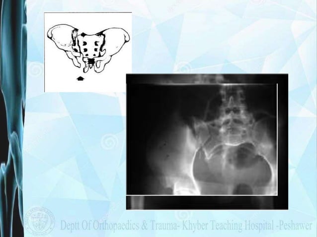 Pelvic fracture classification | PPTX