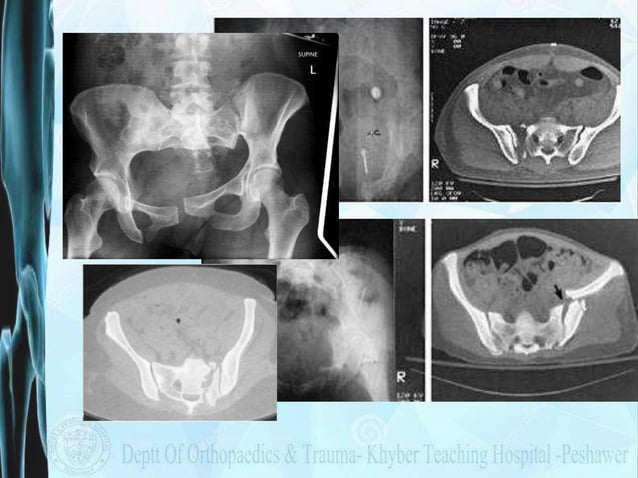 Pelvic fracture classification | PPTX