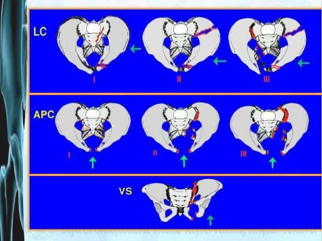 Pelvic fracture classification | PPTX