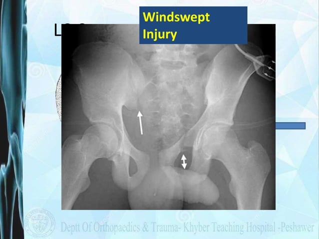 Pelvic fracture classification | PPTX