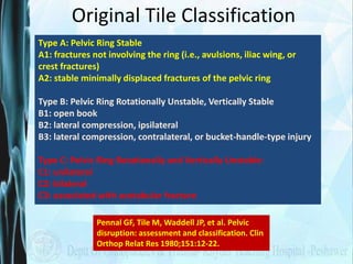 Pelvic fracture classification | PPTX