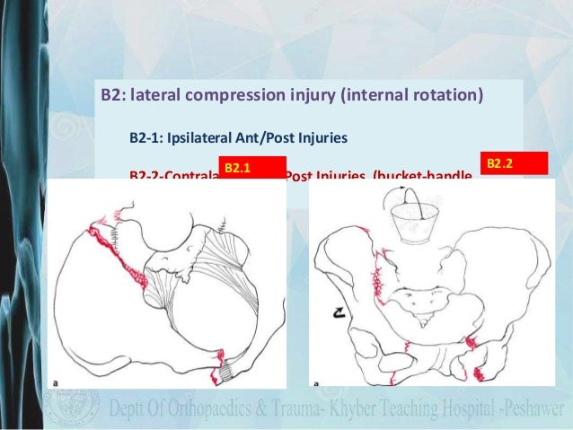 Pelvic fracture classification