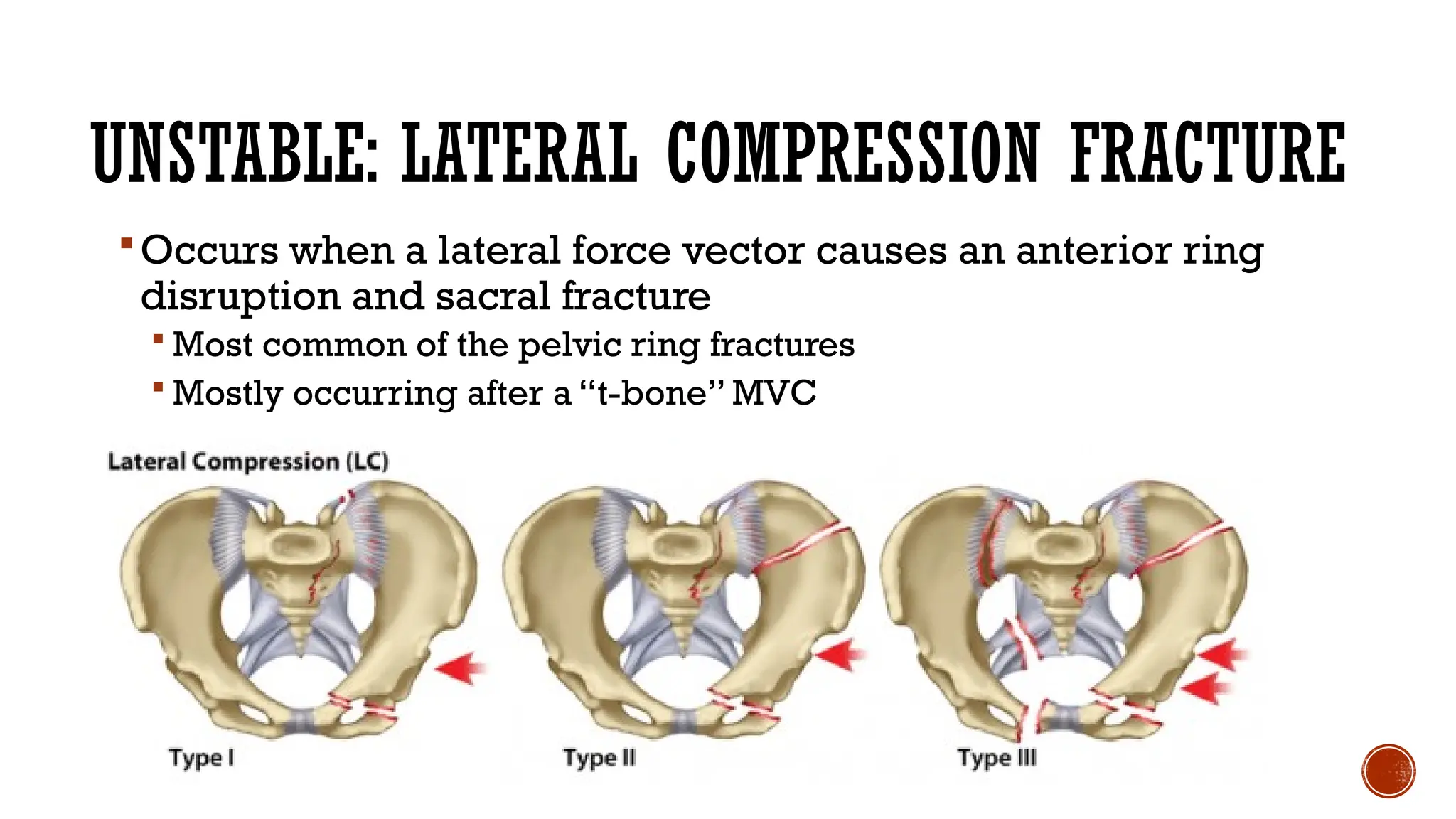 Field management of Pelvic Fracture CME.pptx