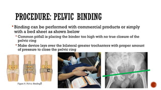 Field management of Pelvic Fracture CME.pptx