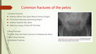 Pelvic fracture basic | PPTX