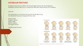 Pelvic fracture basic | PPT