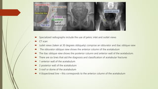 Pelvic fracture basic | PPTX
