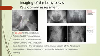 Pelvic fracture basic | PPTX