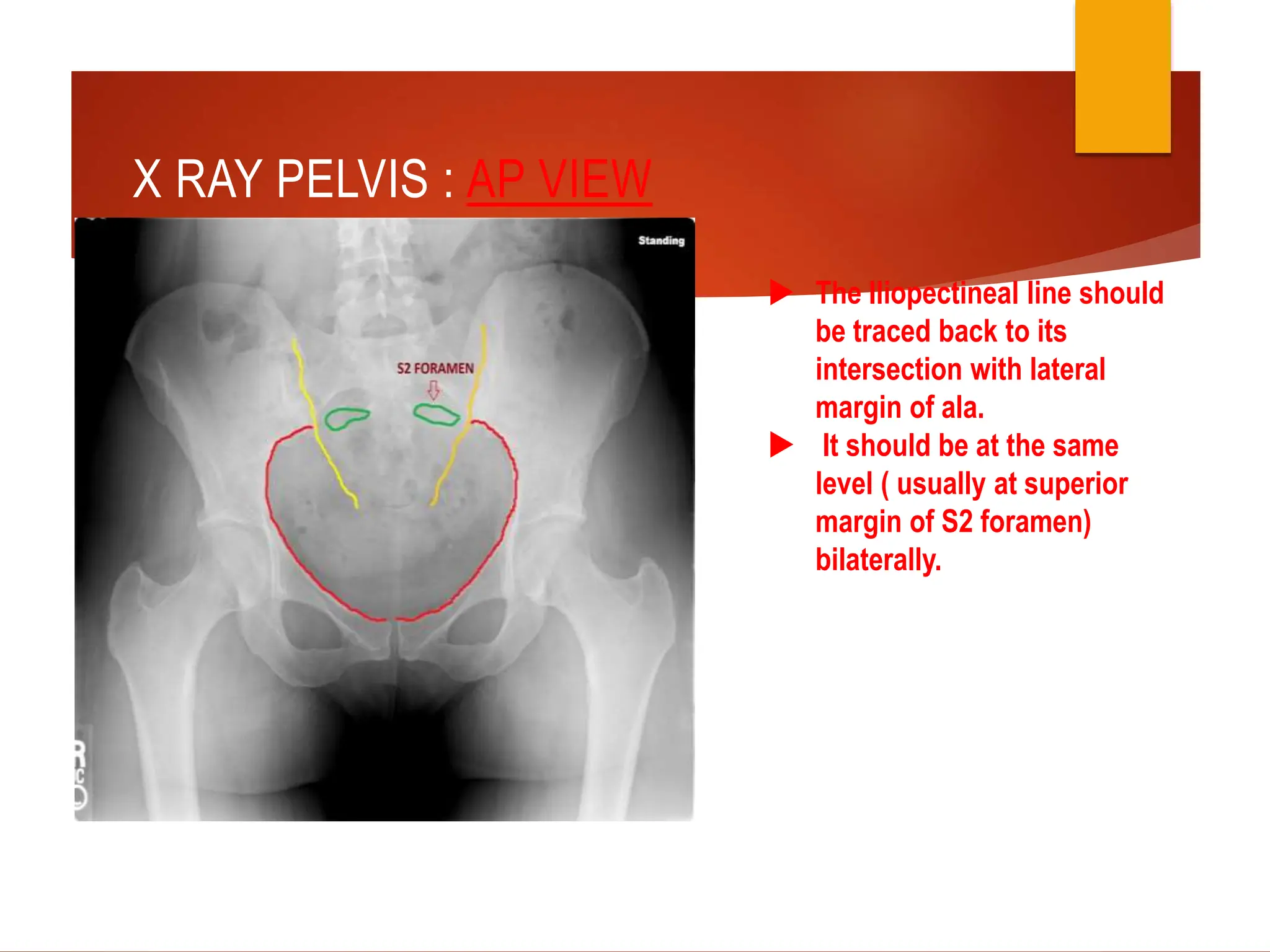 PELVIC FRACTURE ppt by dr.bharti pawar.ppt
