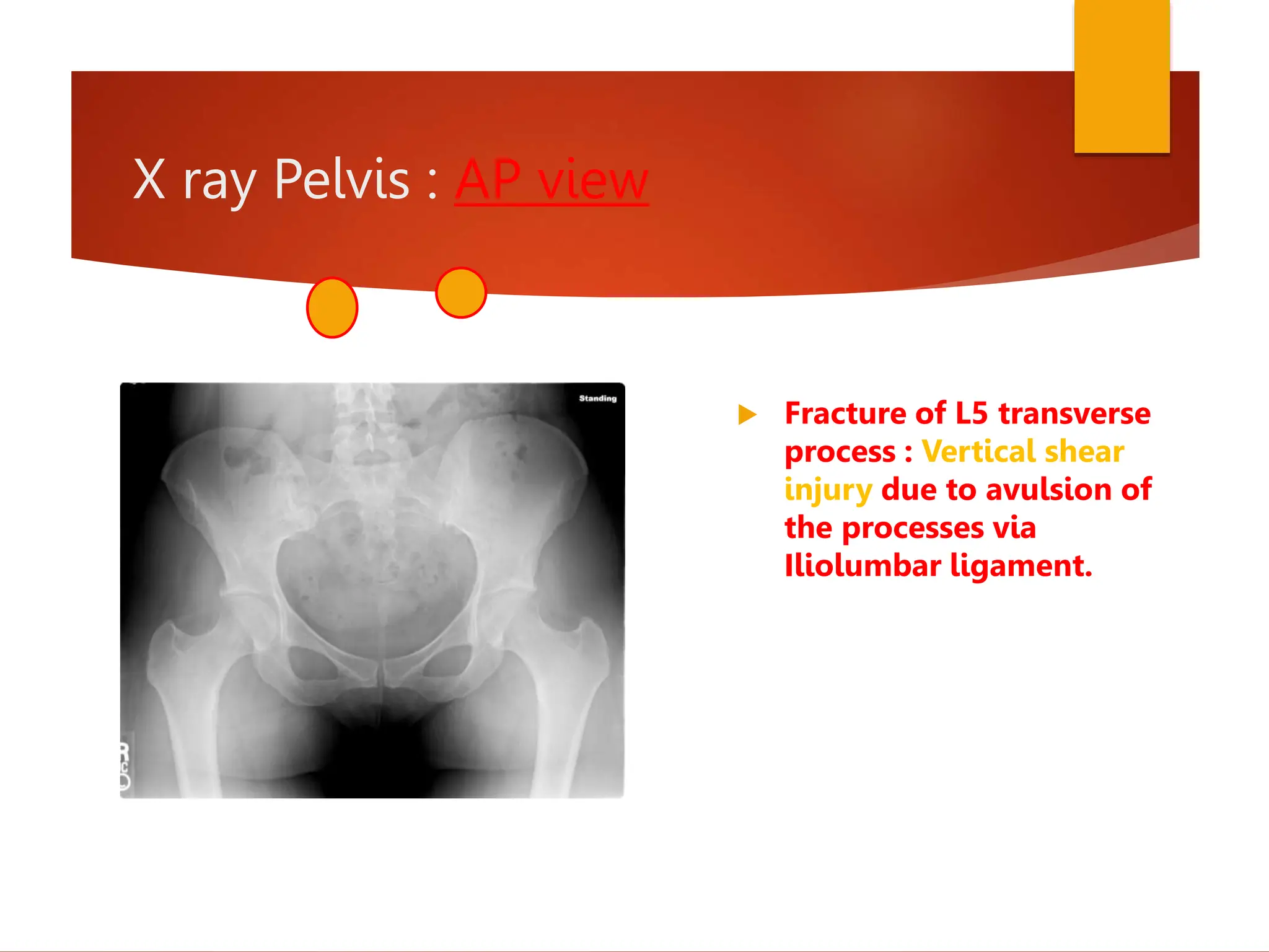 PELVIC FRACTURE ppt by dr.bharti pawar.ppt