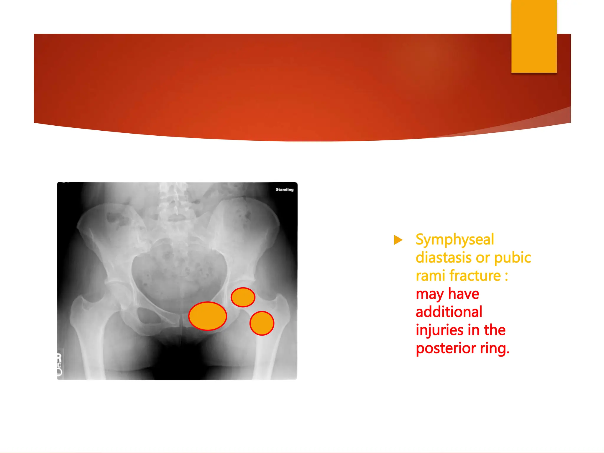 PELVIC FRACTURE ppt by dr.bharti pawar.ppt