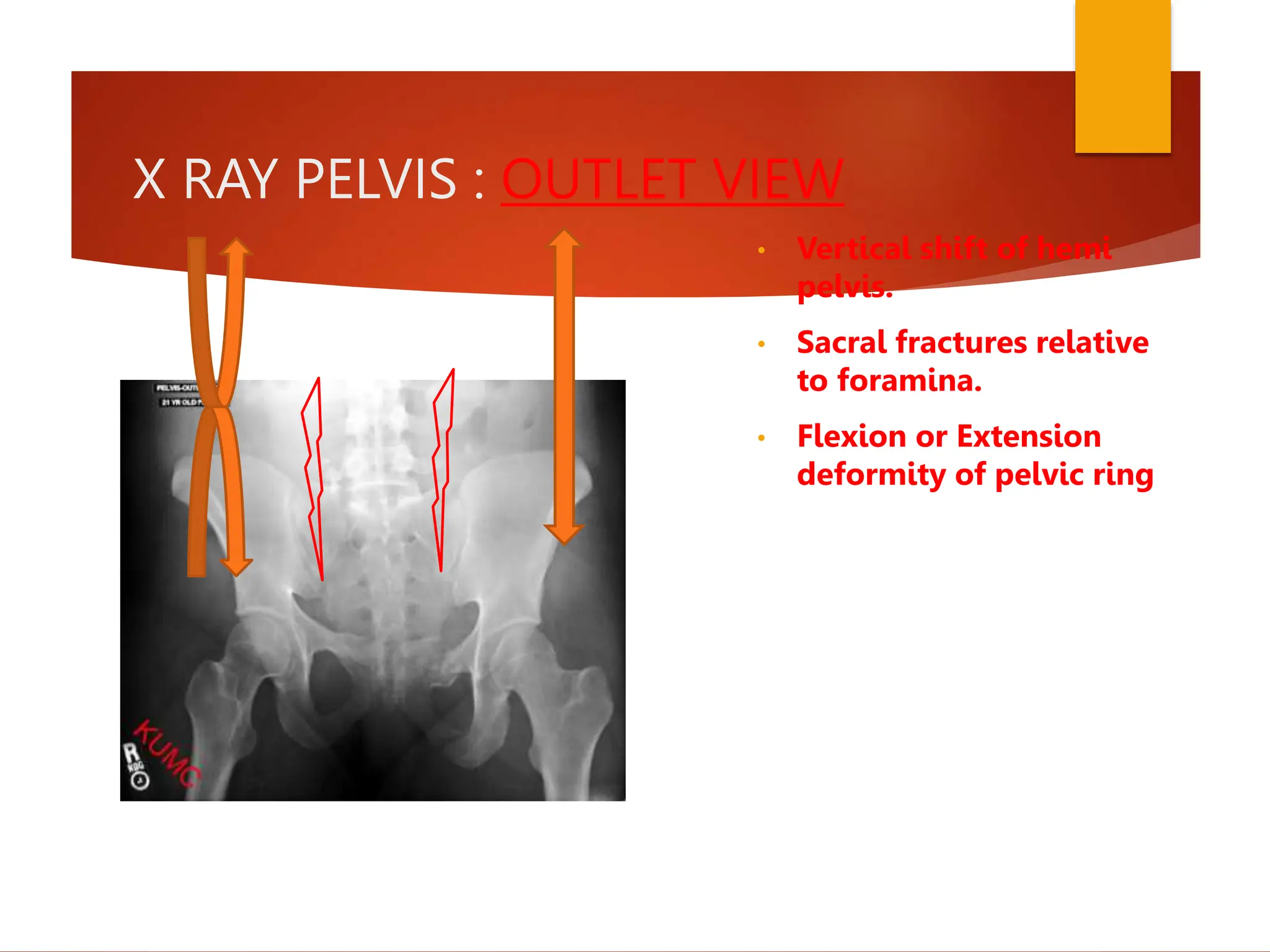 PELVIC FRACTURE ppt by dr.bharti pawar.ppt