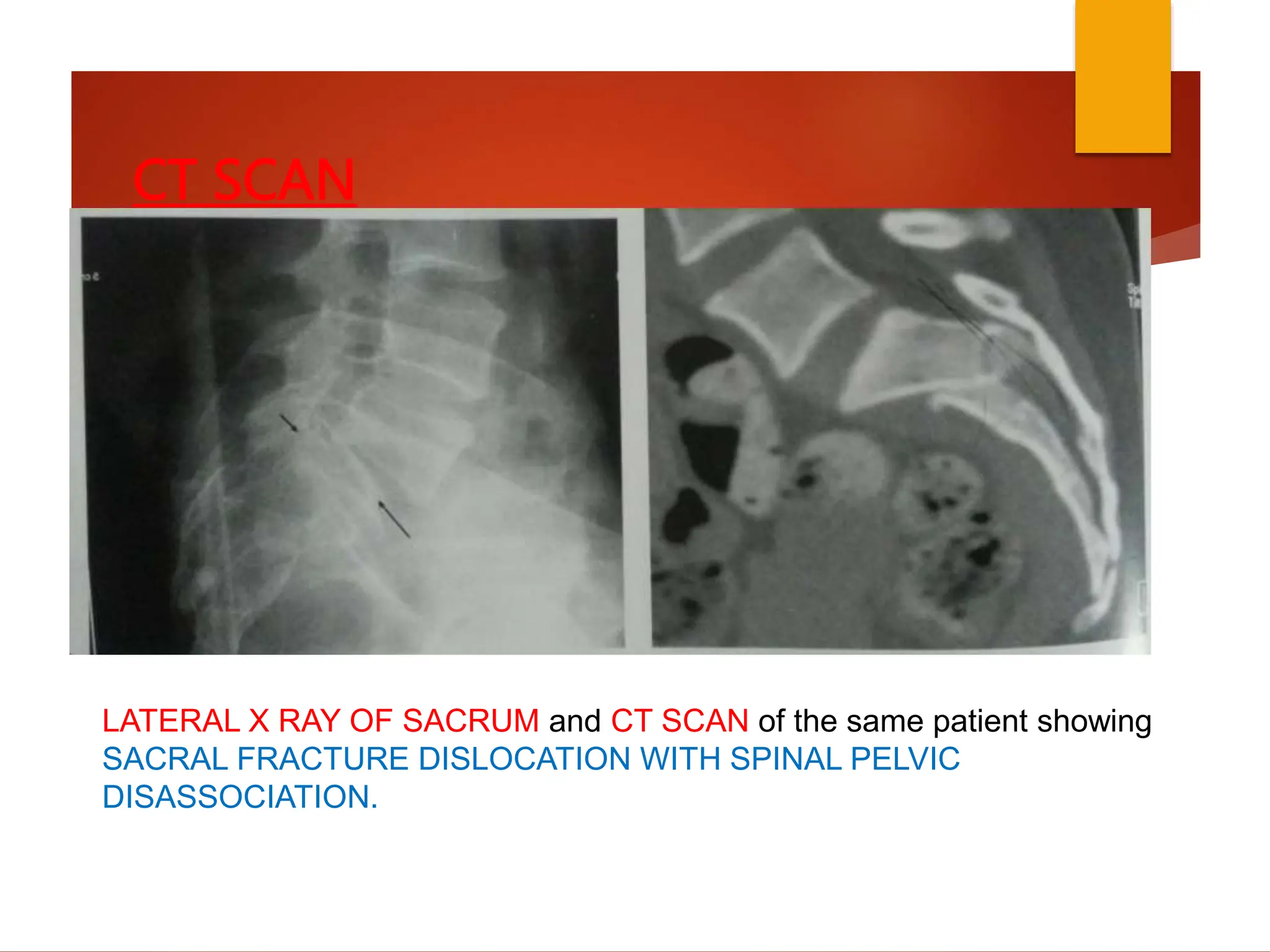 PELVIC FRACTURE ppt by dr.bharti pawar.ppt
