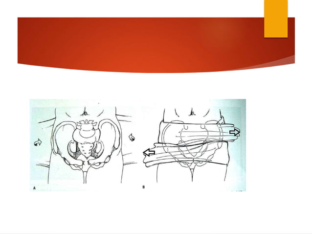 PELVIC FRACTURE ppt by dr.bharti pawar.ppt