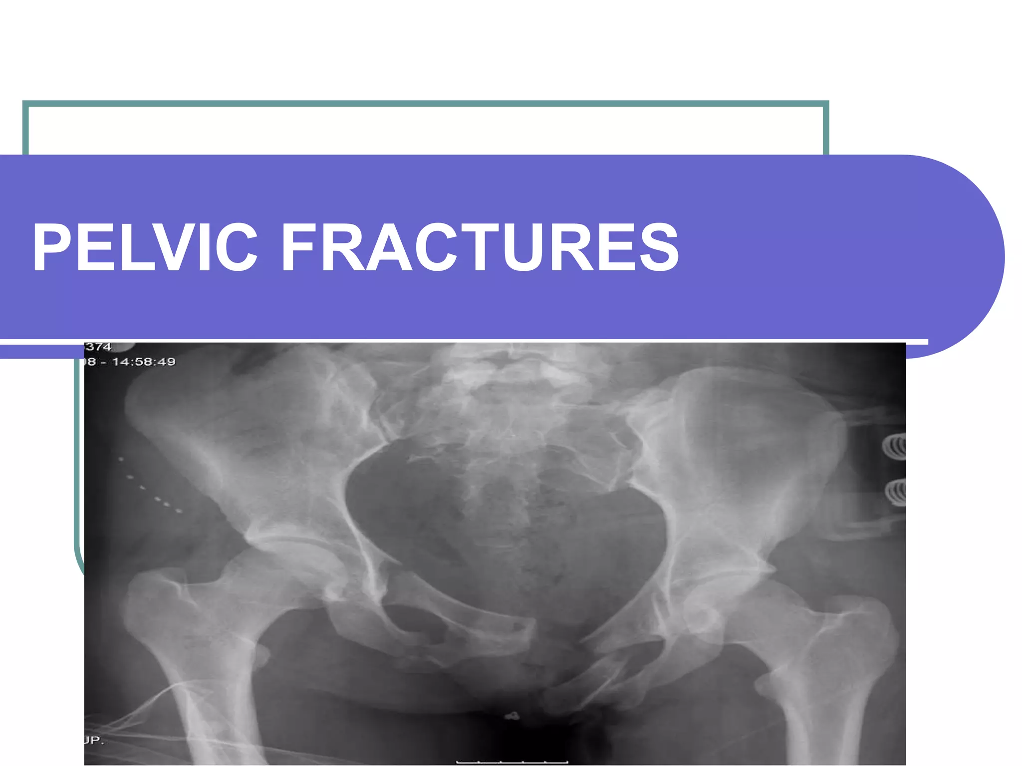 Pelvic fractures | PPT
