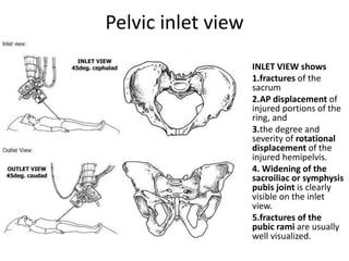 Pelvic Inlet And Outlet Views