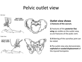 Pelvic Inlet View
