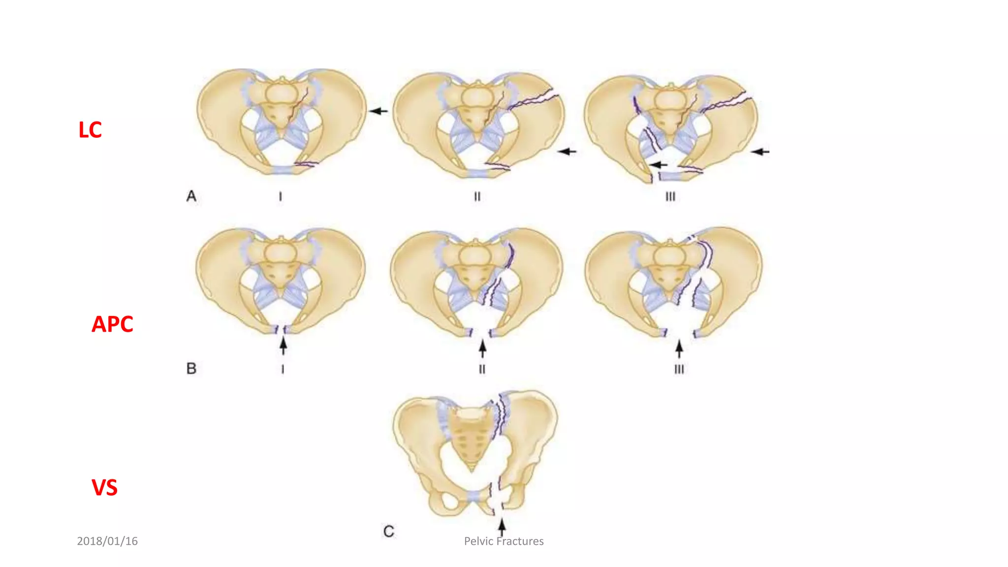 Pelvic fractures | PPTX