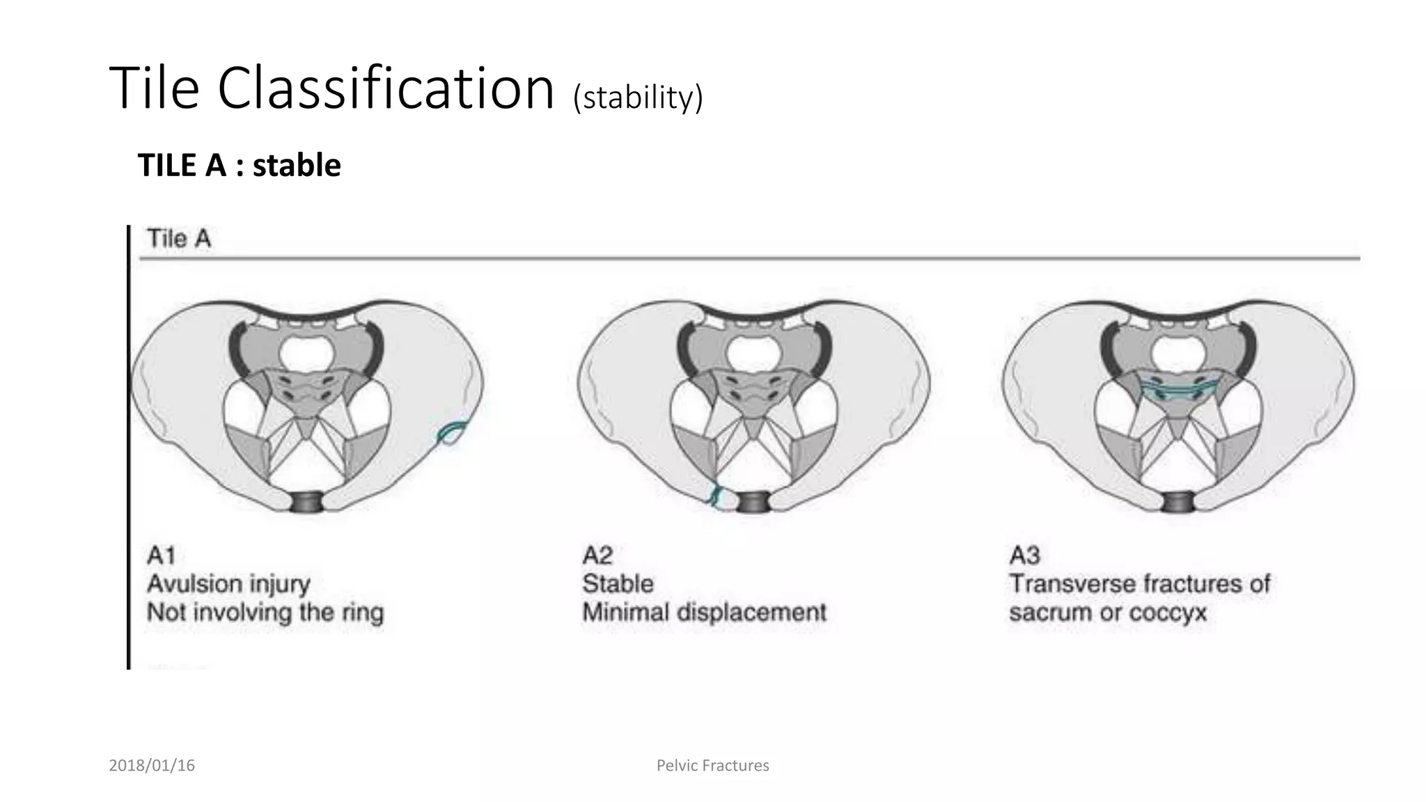 Pelvic fractures | PPTX