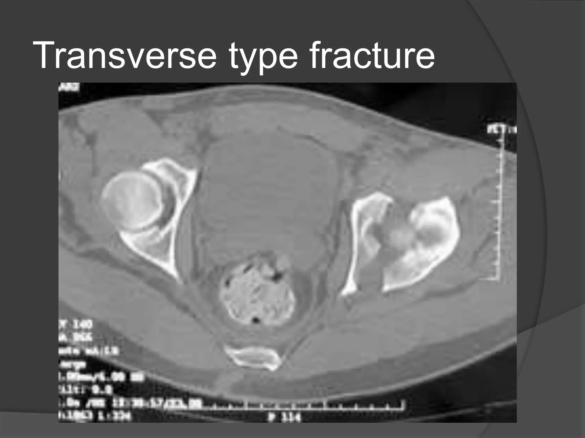 Pelvic Fracturespptx