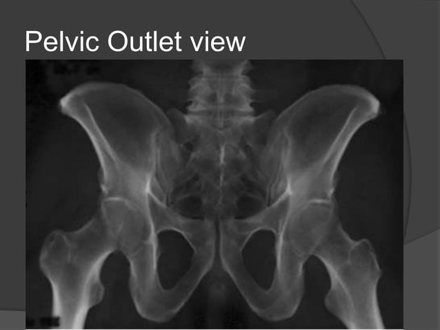Pelvic fractures.pptx