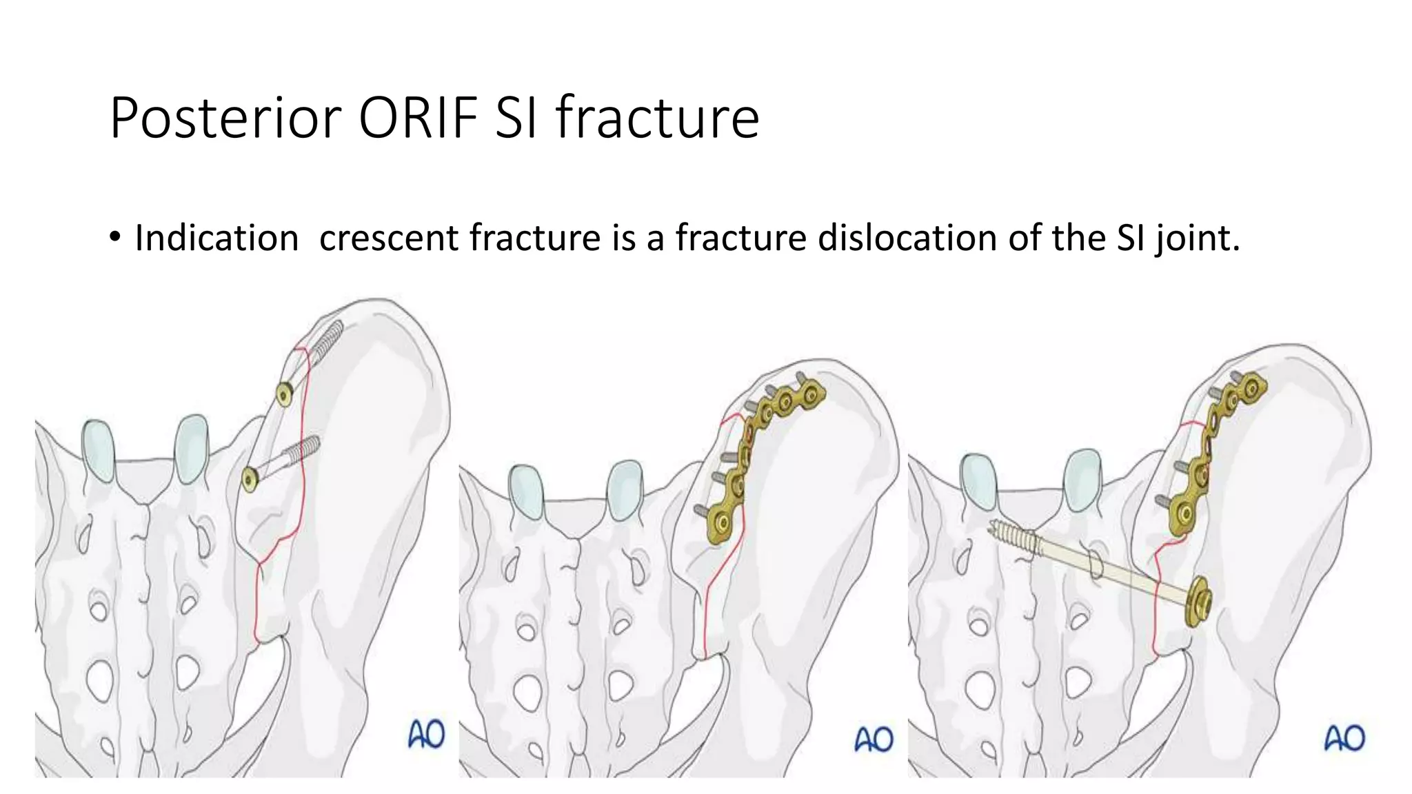 pelvic fractures.pptx