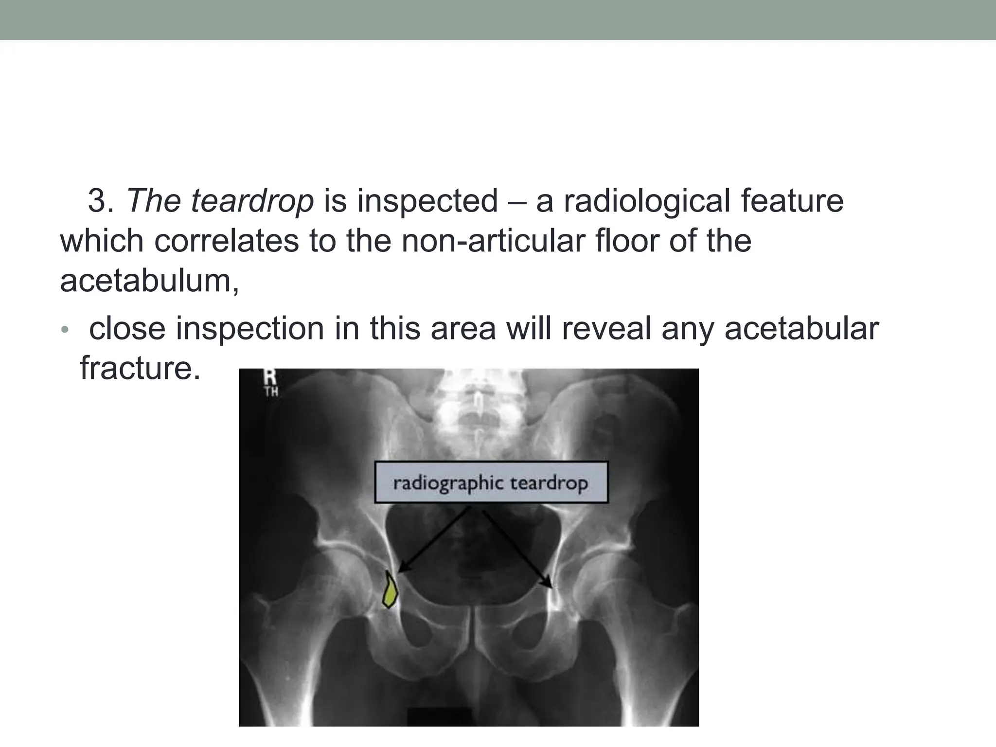 pelvic fractures.pptx