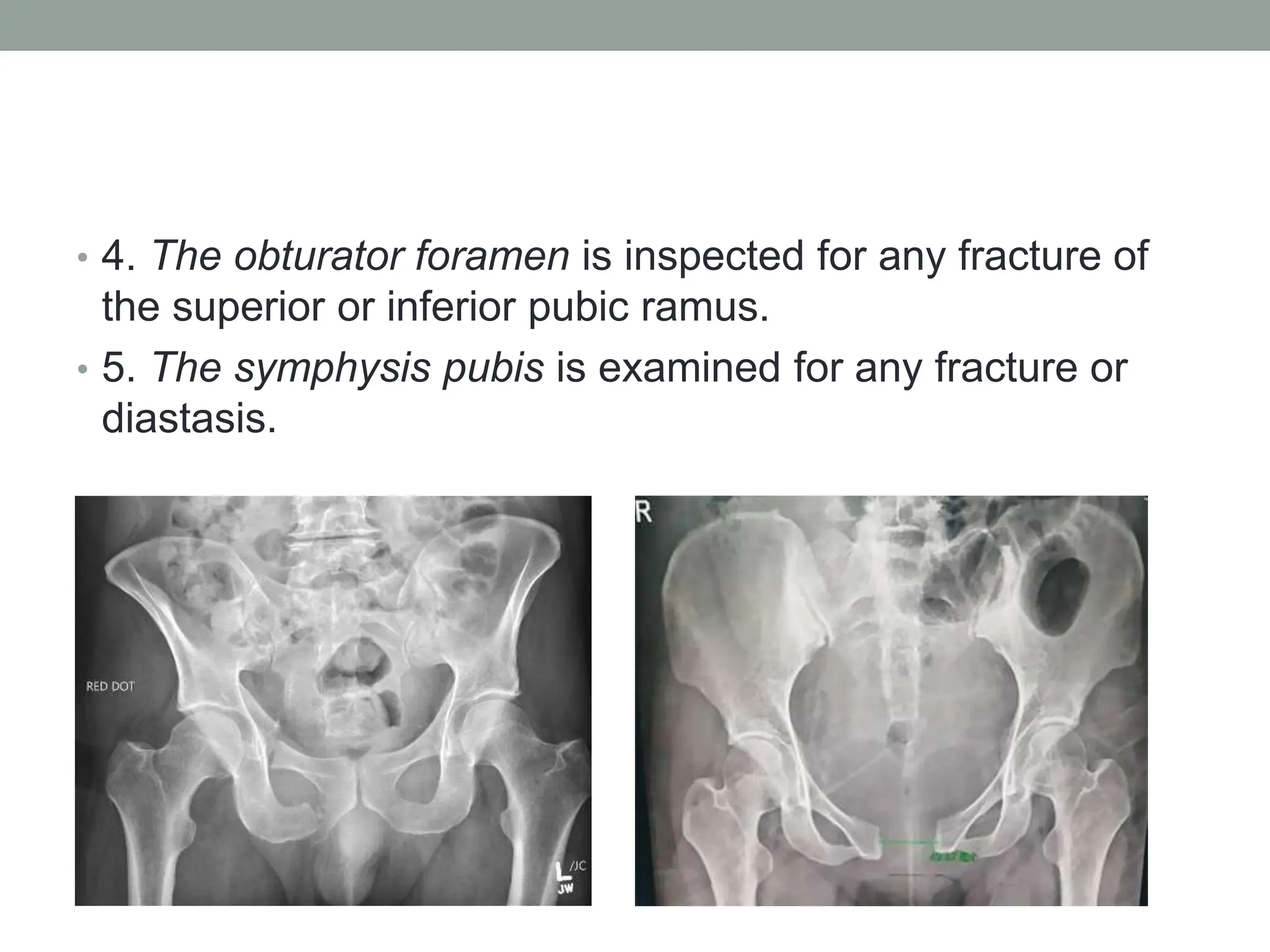 pelvic fractures.pptx
