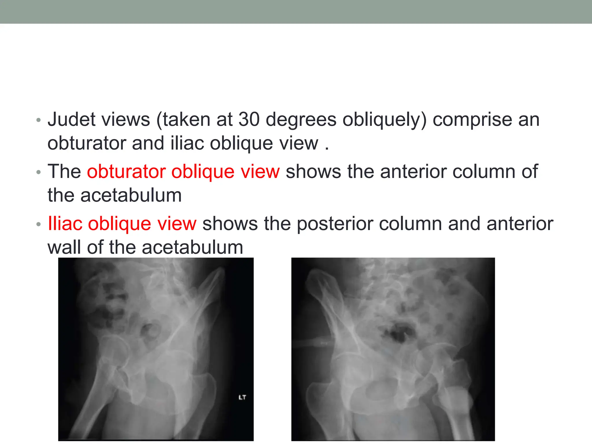 pelvic fractures.pptx