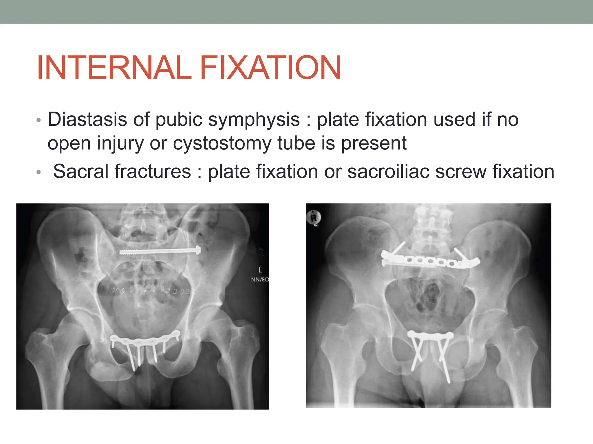 pelvic fractures.pptx