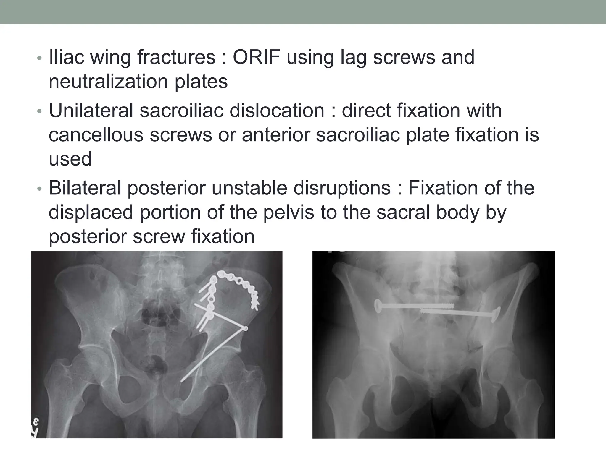 pelvic fractures.pptx