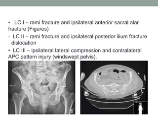 pelvic fractures.pptx