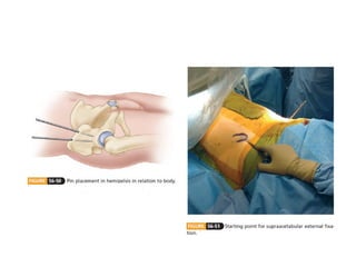 Pelvic Fractures - Final.pptx my fin arse | PPTX