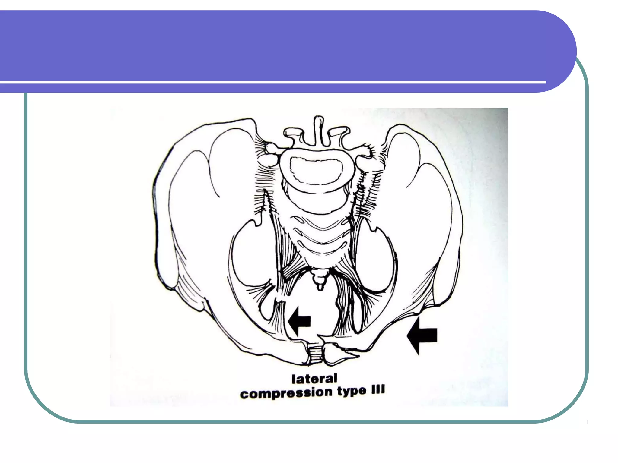 Pelvic fractures classification and management | PPT