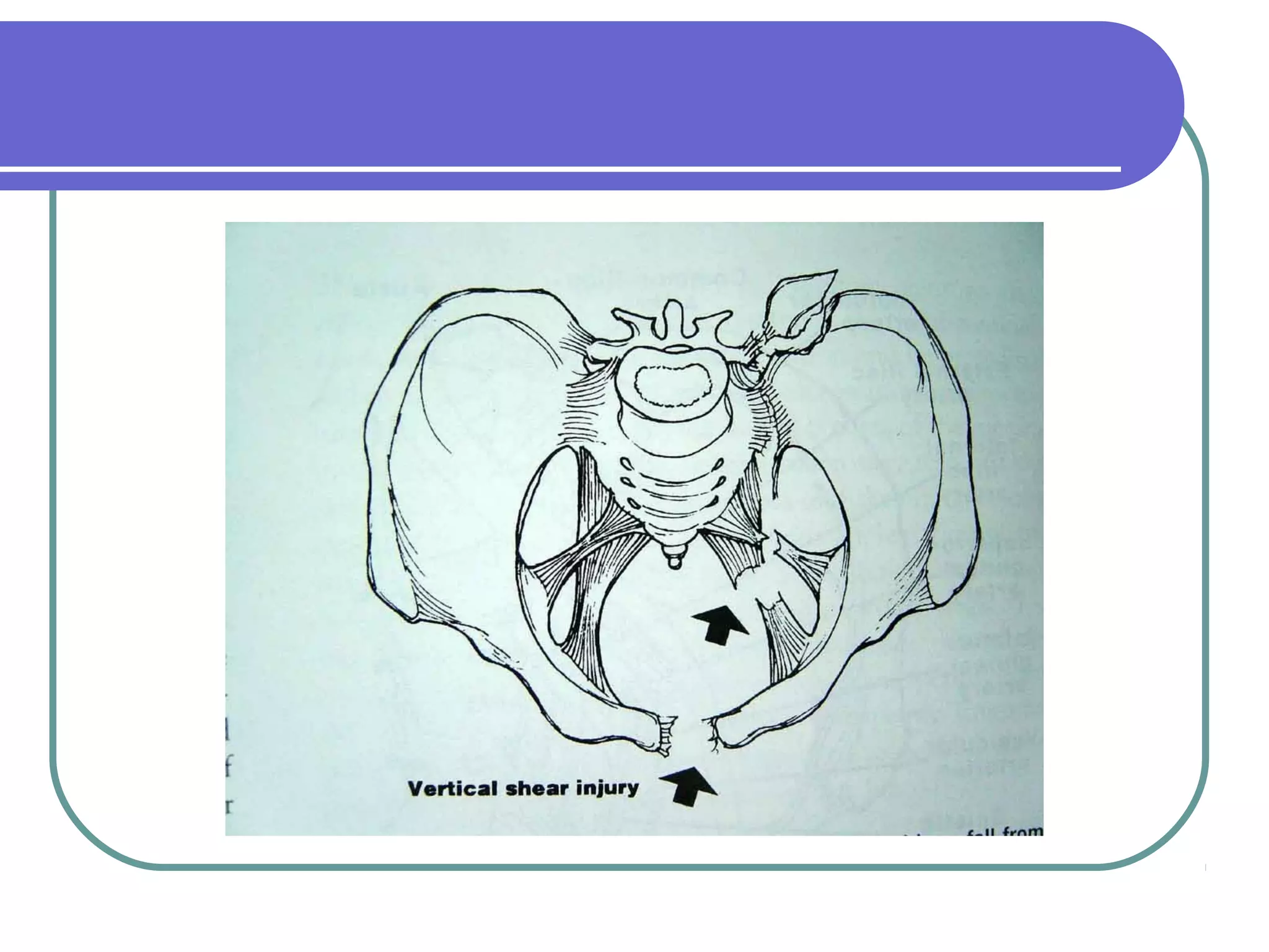 Pelvic fractures classification and management | PPT