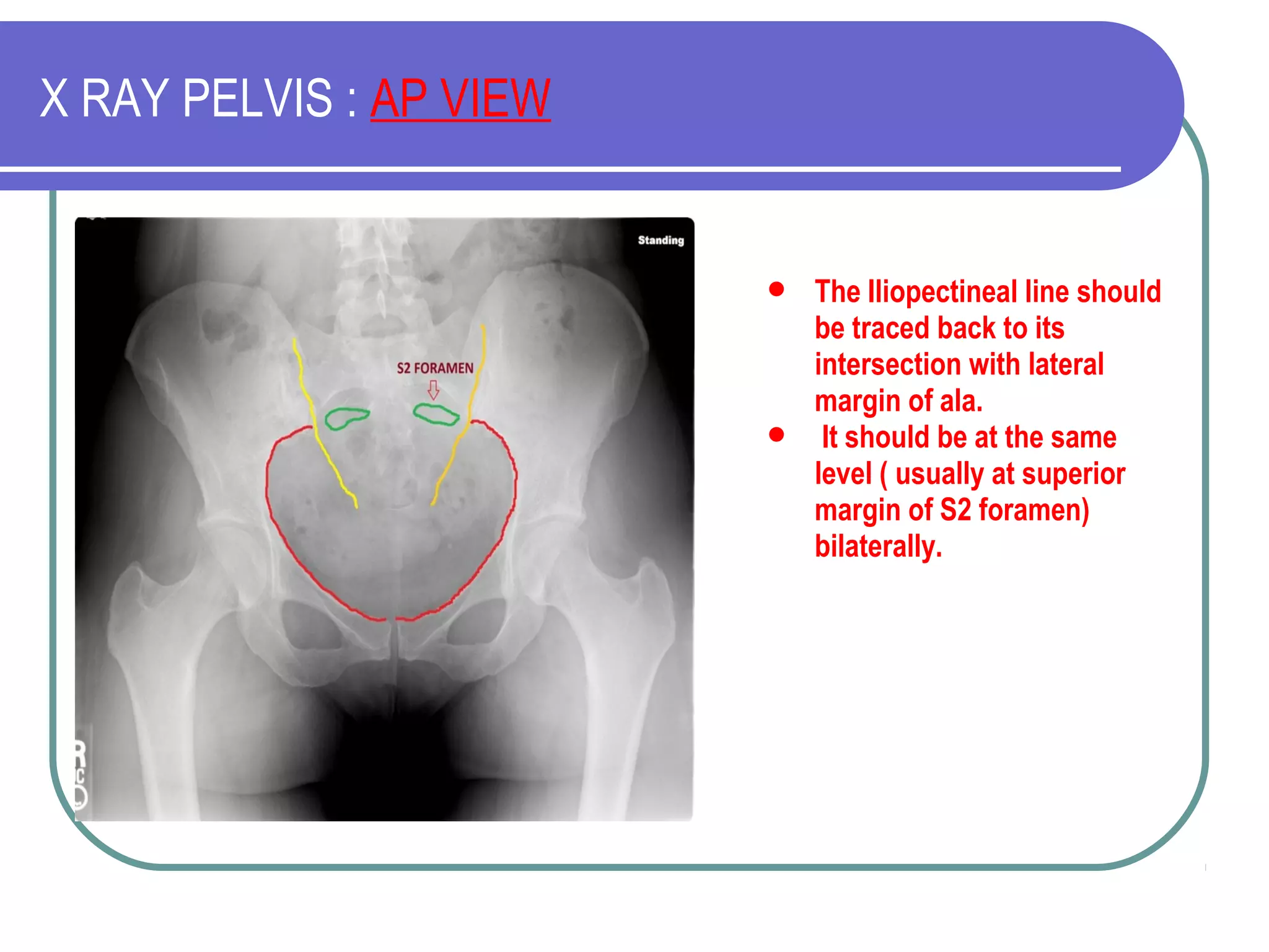 Pelvic fractures classification and management | PPT