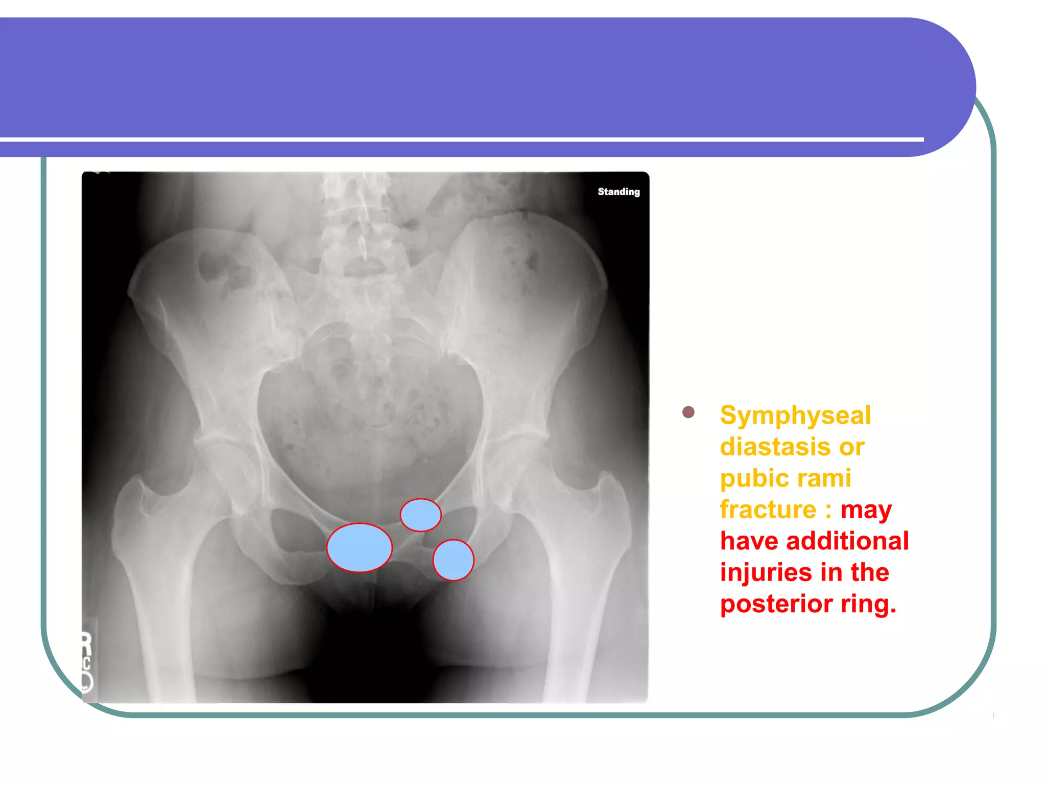 Pelvic fractures classification and management | PPT