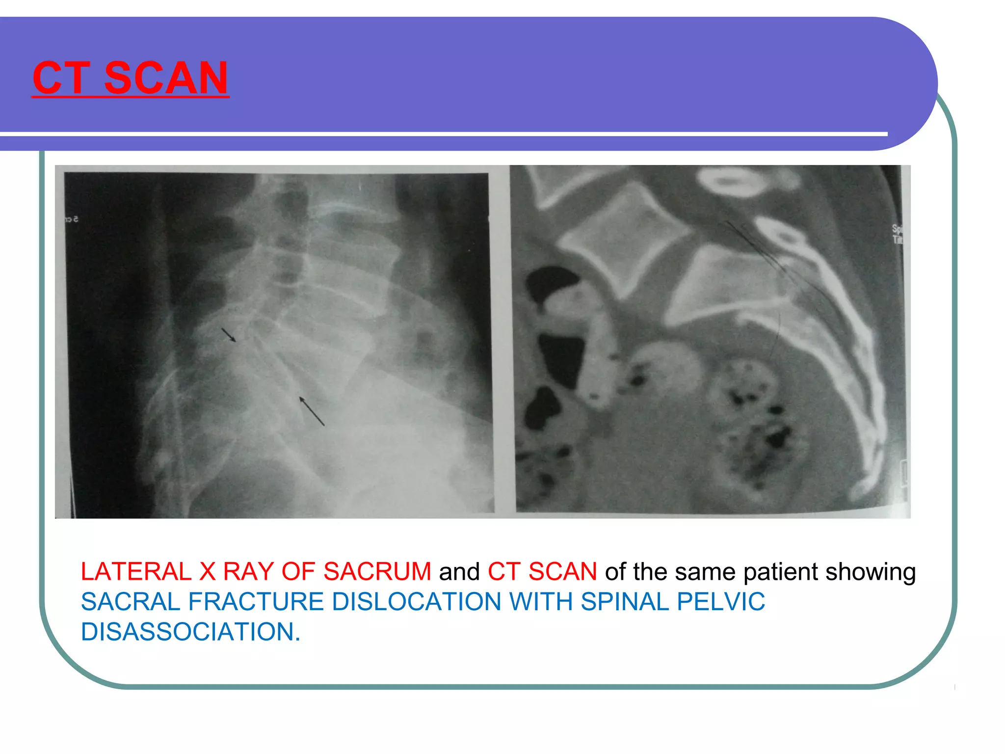 Pelvic fractures classification and management | PPT