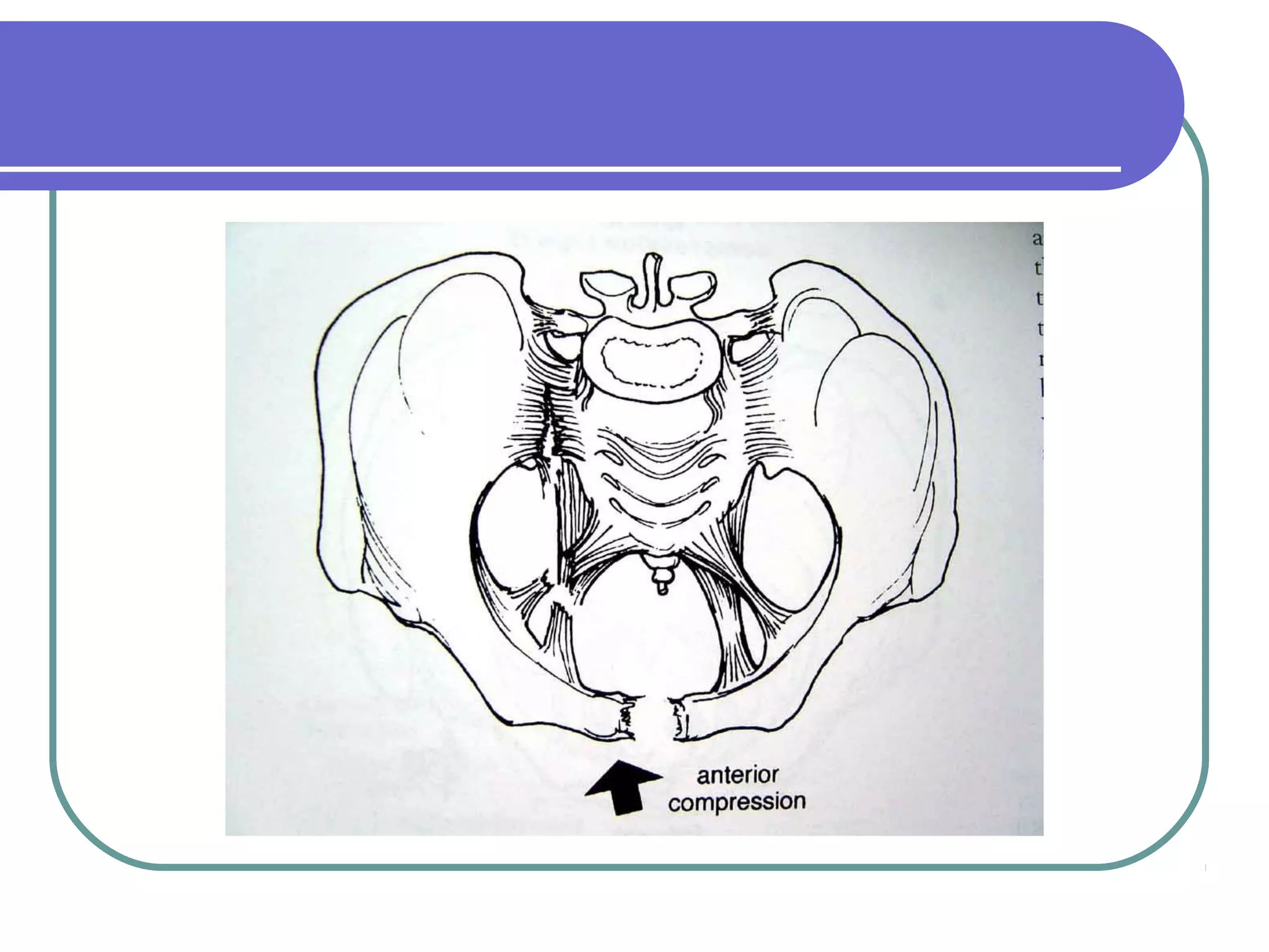 Pelvic fractures classification and management | PPT