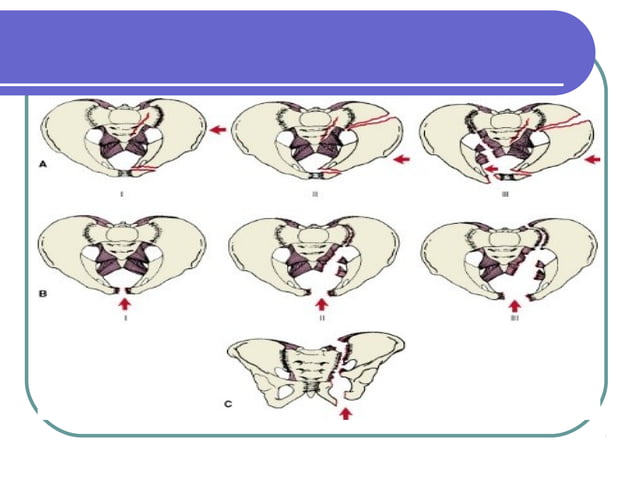 Pelvic fractures classification and management | PPT | Death, Injury ...