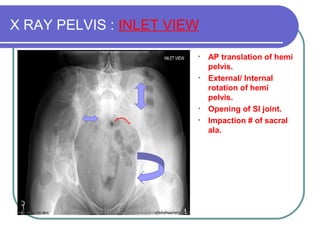 Pelvic Inlet View