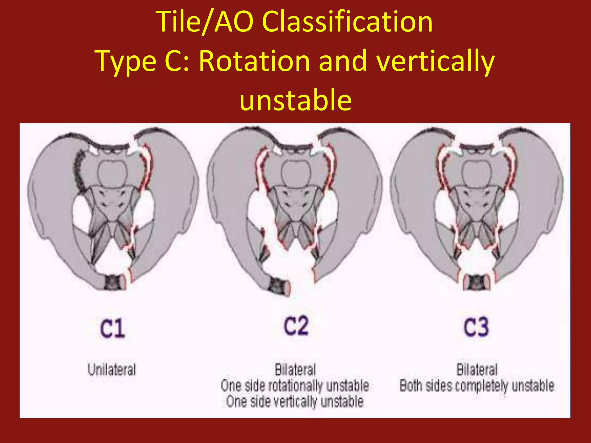 Pelvic fractures and Physiotherapy | PPTX