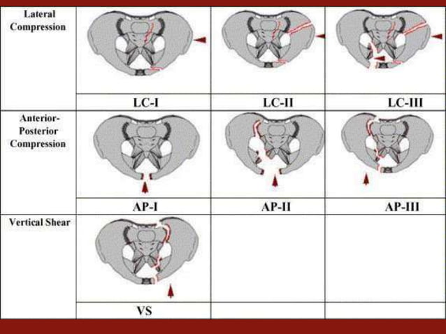 Pelvic fractures and Physiotherapy | PPTX