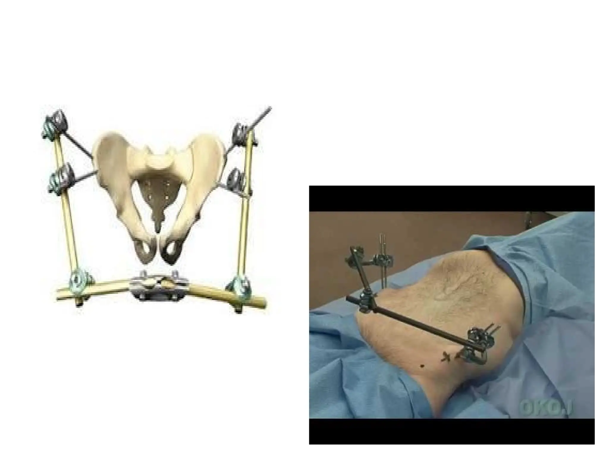 PELVIC FRACTURES in orthopaedics FINAL.pptx